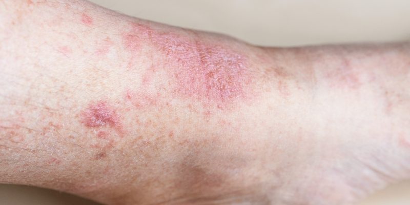Todo lo que debes saber sobre el eczema - Doctoranytime Blog