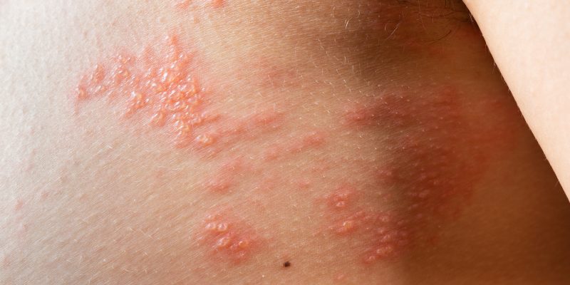 Cómo identificar y tratar las infecciones cutáneas